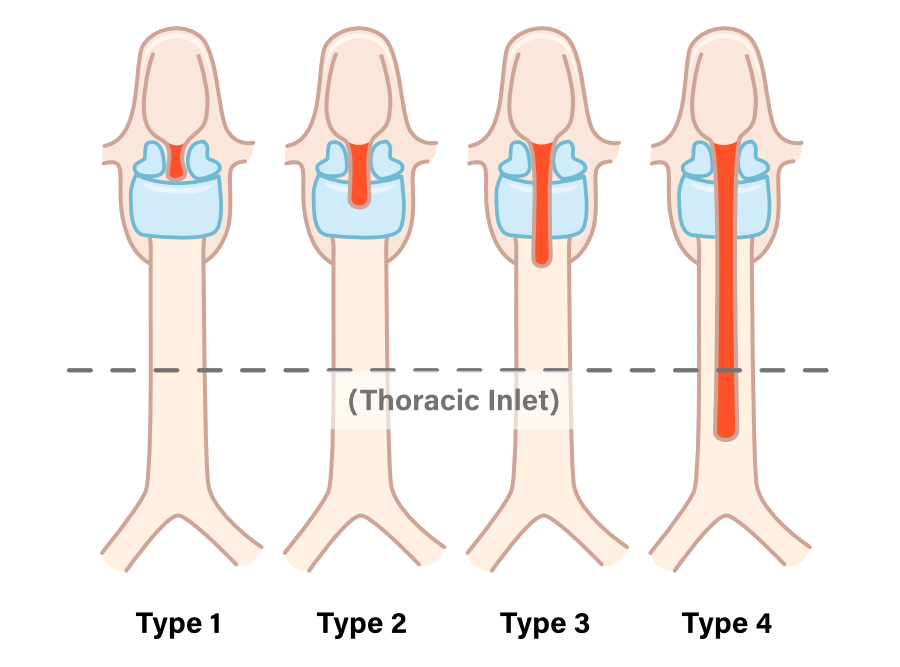 Benjamin Inglis Classification Of Laryngeal Clefts